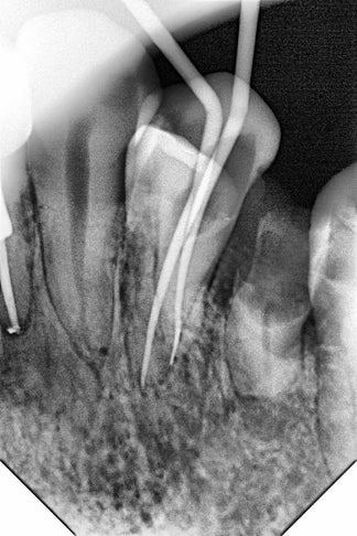 Woodpecker i-Sensor Digital Intra-Oral X-Ray Sensor - H1, H1.5, H2 ...